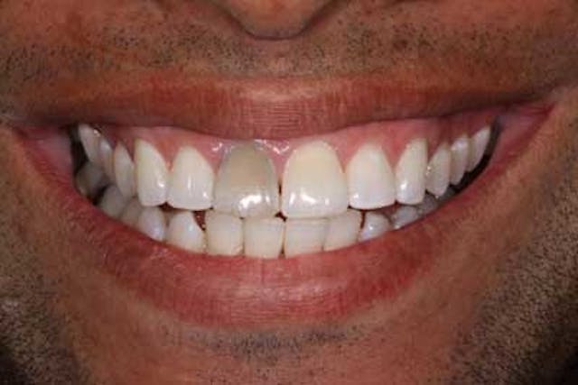 The power of preparation: How to ensure proper gingival zenith position ...