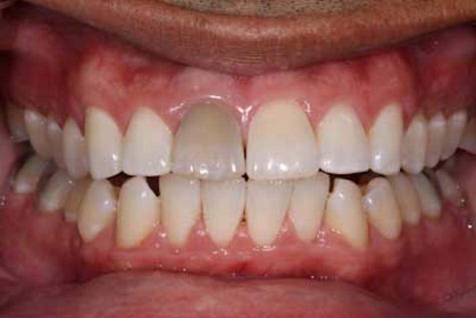 The power of preparation: How to ensure proper gingival zenith position ...