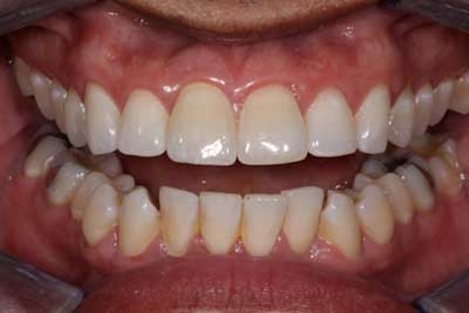 The power of preparation: How to ensure proper gingival zenith position ...