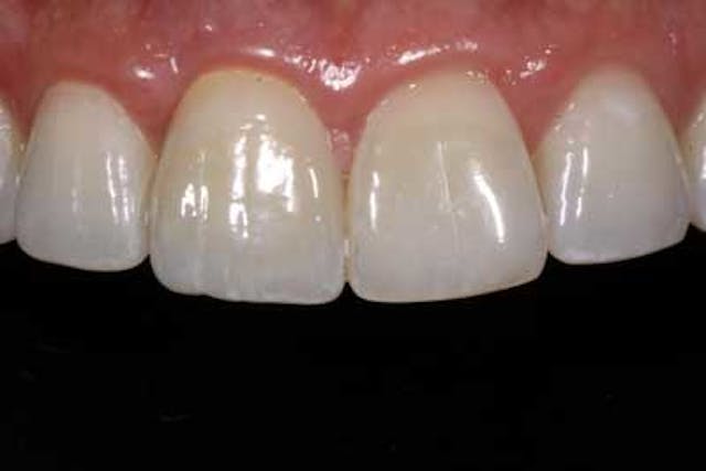 The power of preparation: How to ensure proper gingival zenith position ...