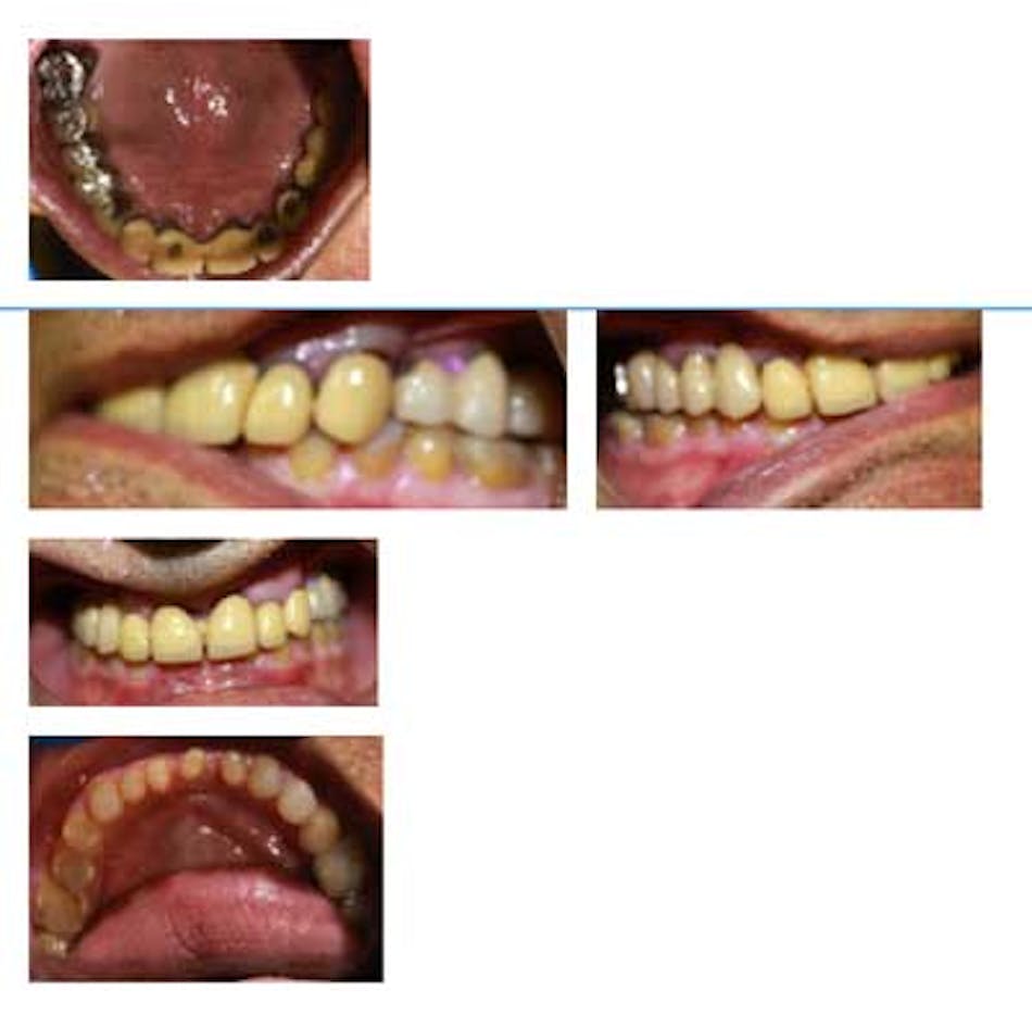 Opening vertical dimension: how do you do it? | Perio Implant Advisory