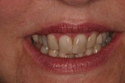 Clinical dental advantages of the apically positioned flap | Perio ...