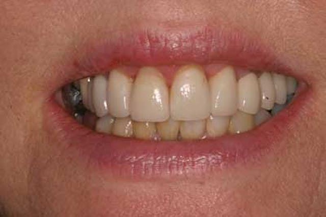 Clinical dental advantages of the apically positioned flap | Perio ...