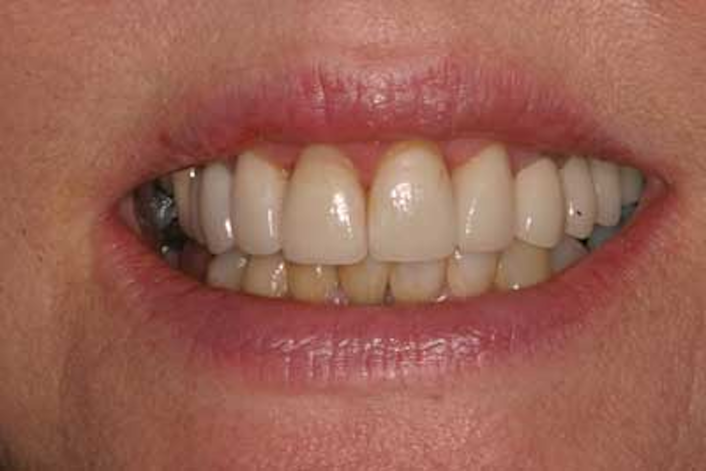 Clinical dental advantages of the apically positioned flap | Perio ...