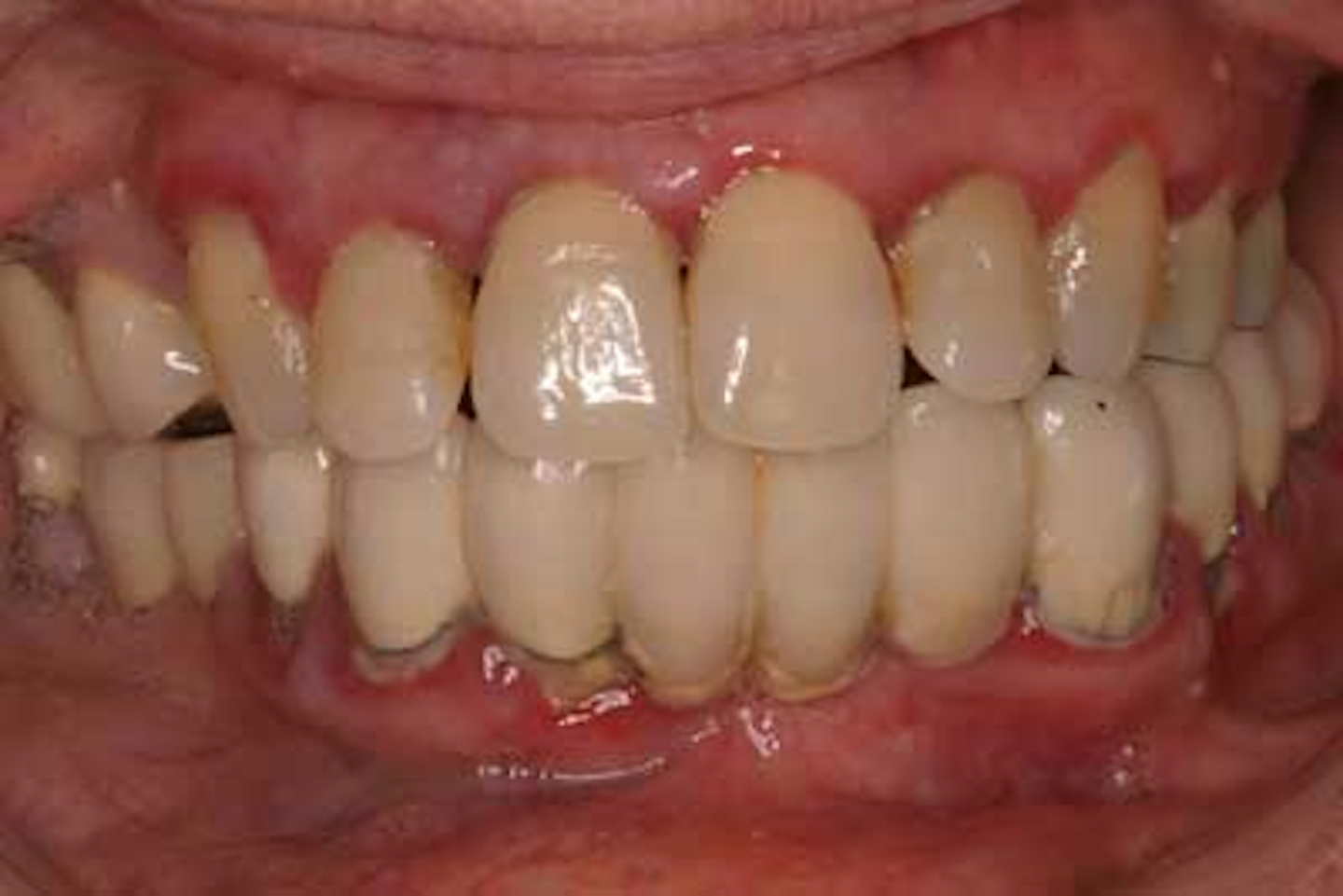 Clinical dental advantages of the apically positioned flap | Perio ...