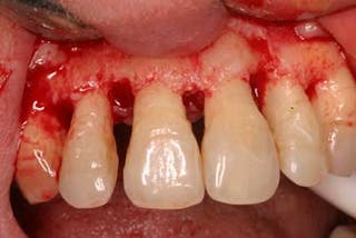 Clinical dental advantages of the apically positioned flap | Perio ...