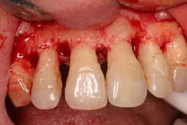 Clinical dental advantages of the apically positioned flap | Perio ...