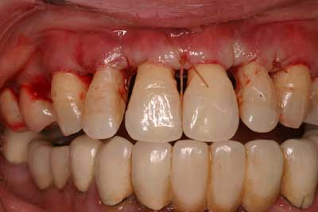 Clinical dental advantages of the apically positioned flap | Perio ...