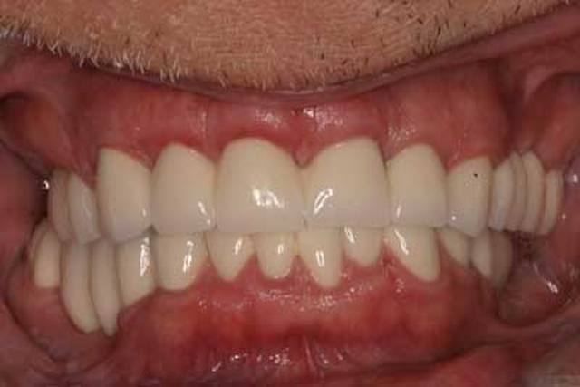 Restoration of a damaged dental implant due to removal of a fractured ...