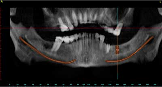 Restoration of a damaged dental implant due to removal of a fractured ...