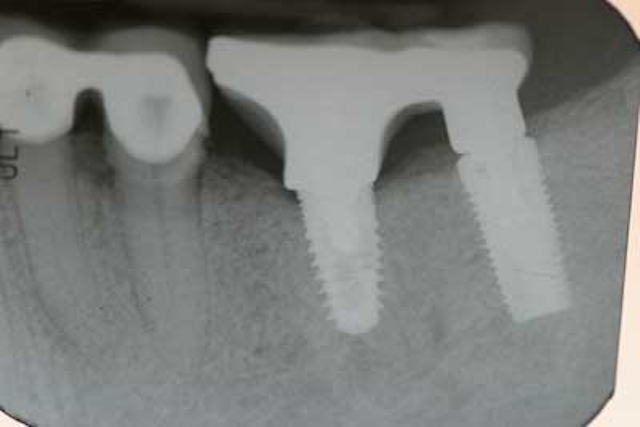 Restoration of a damaged dental implant due to removal of a fractured ...