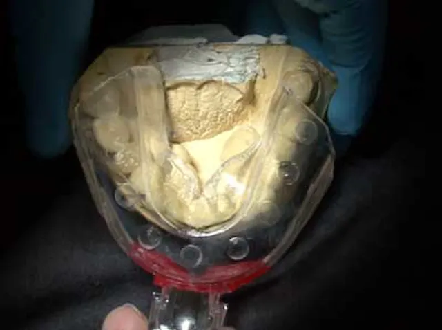 Making accurate dental impressions when faced with anatomical ...