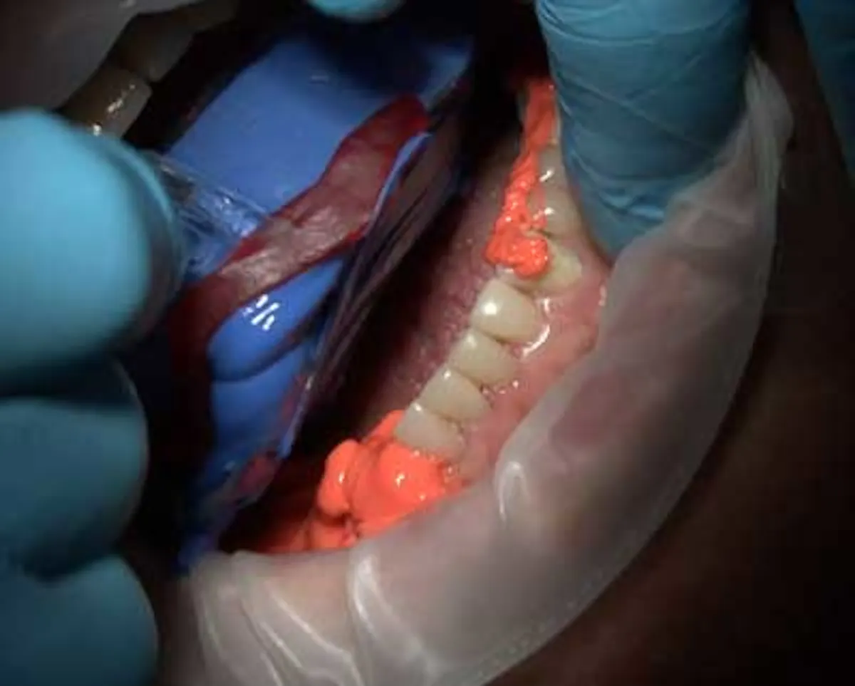 Making accurate dental impressions when faced with anatomical ...