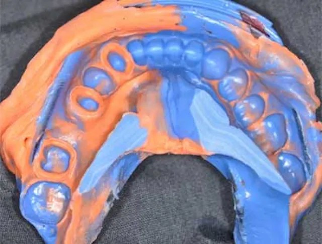 Making accurate dental impressions when faced with anatomical ...