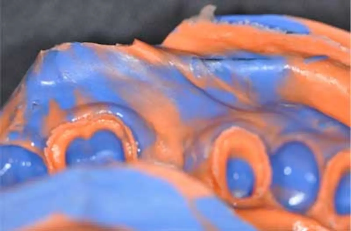 Making accurate dental impressions when faced with anatomical ...