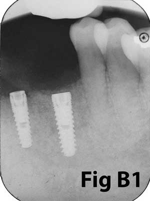 Attached gingiva and dental implants | Perio Implant Advisory