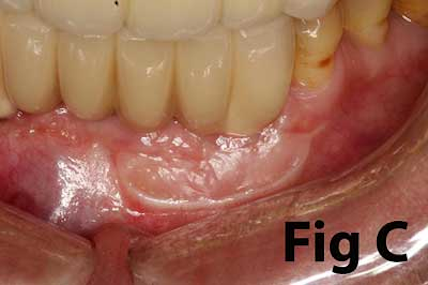 Attached gingiva and dental implants | Perio-Implant Advisory