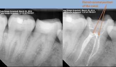 Step-by-step procedure to simplified and efficient root canal ...