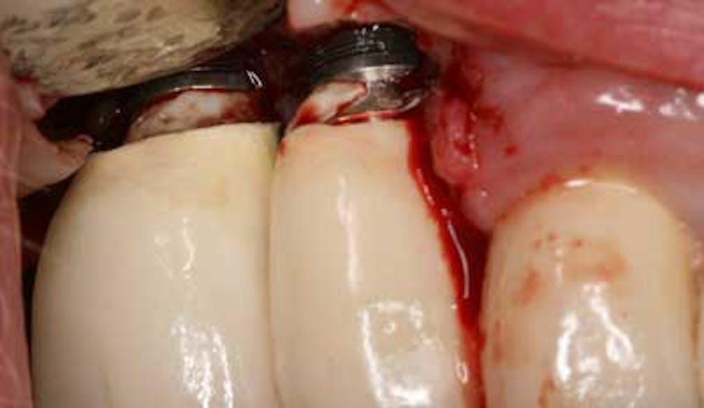 Detecting cement in the peri-implant sulcus | Perio Implant Advisory