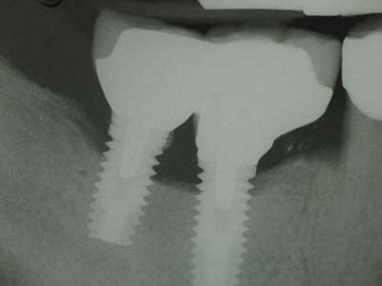 Detecting cement in the peri-implant sulcus | Perio Implant Advisory