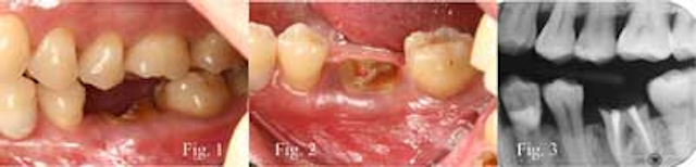 'My implant is too shallow and now I'm getting food stuck between my ...
