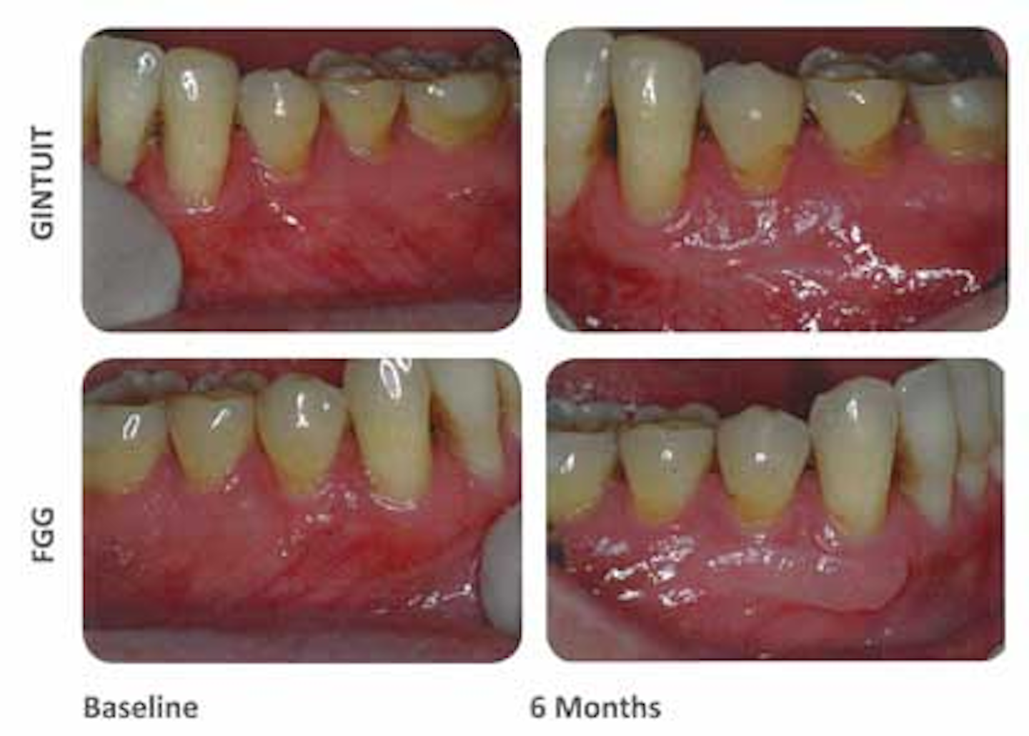 Is it time to retire the free gingival graft procedure in light of new ...