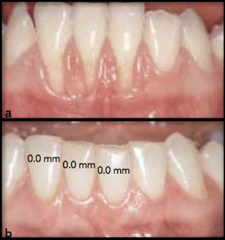 Is it time to retire the free gingival graft procedure in light of new ...