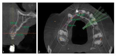 Ridge Augmentation | Perio Implant Advisory