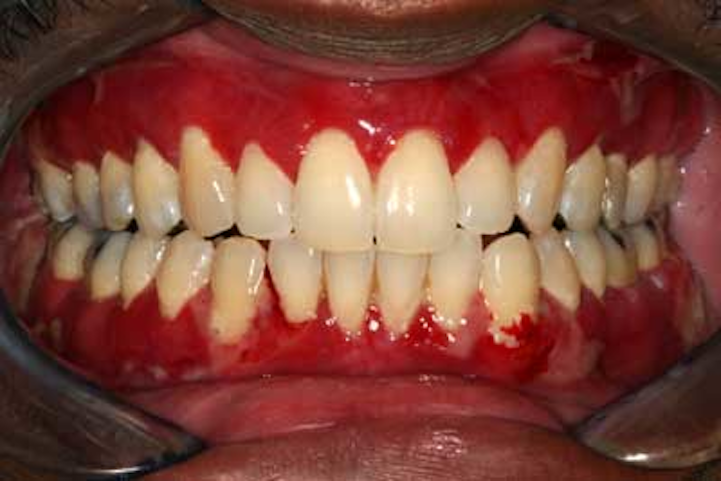 Inflammation of the gingiva: The other reasons besides the obvious ...