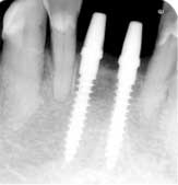Narrow diameter dental implants in the esthetic zone | Perio Implant ...