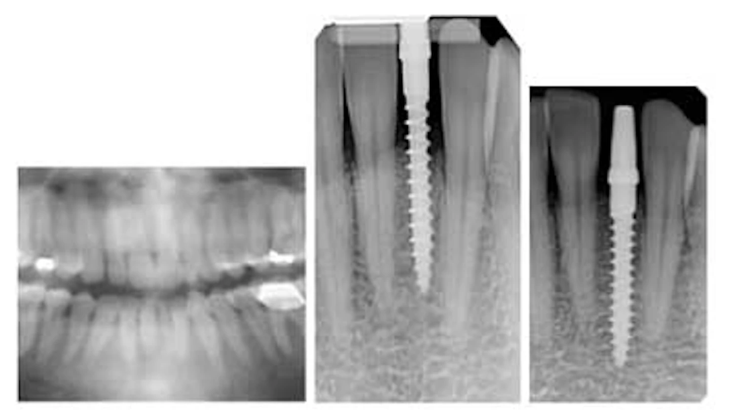 Narrow diameter dental implants in the esthetic zone | Perio-Implant ...
