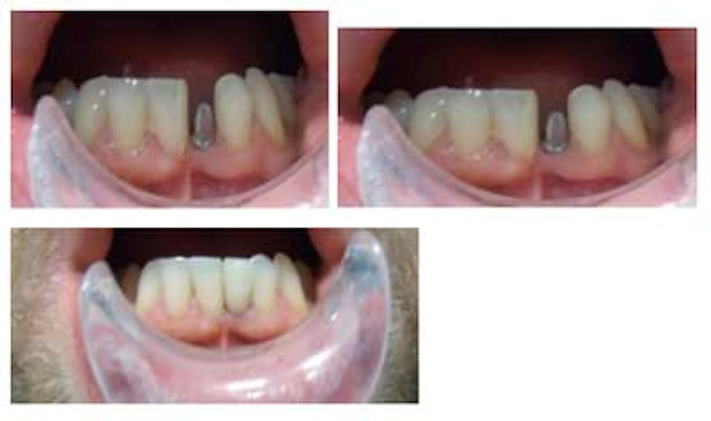 Narrow diameter dental implants in the esthetic zone | Perio-Implant ...