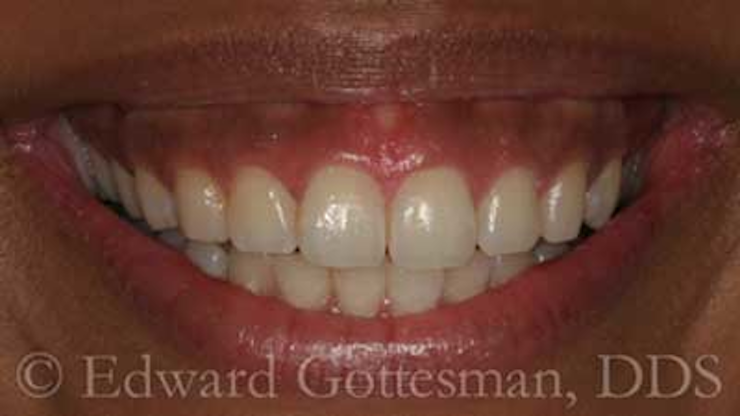 Excessive gingival display: addressing multiple etiologies for optimal ...