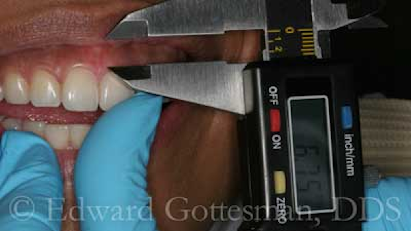Excessive gingival display: addressing multiple etiologies for optimal ...