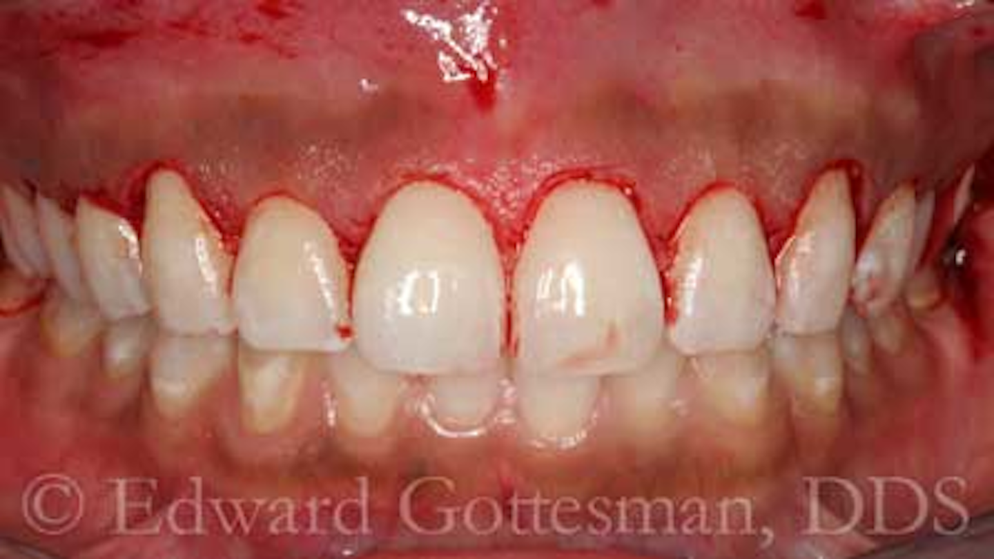 Excessive gingival display: addressing multiple etiologies for optimal ...