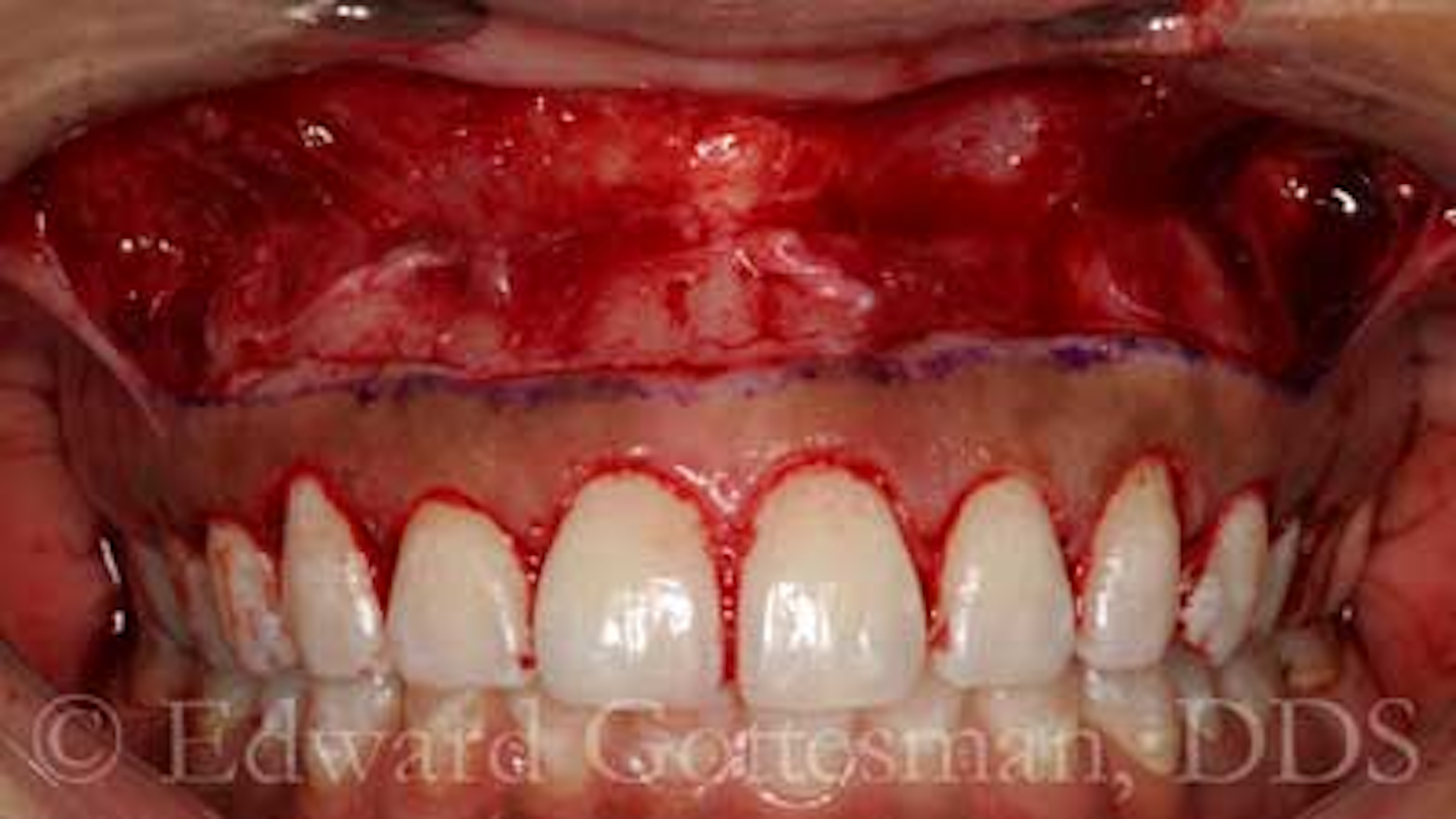 Excessive gingival display: addressing multiple etiologies for optimal ...