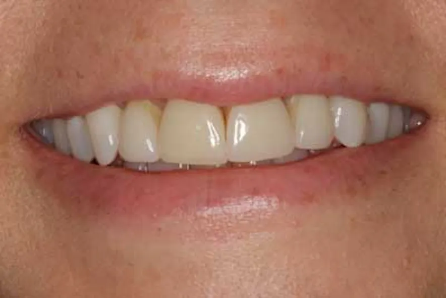 Fabricating IPS e.max veneers step-by-step | Perio Implant Advisory