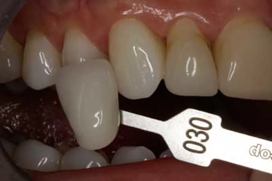 Fabricating IPS e.max veneers step-by-step | Perio Implant Advisory