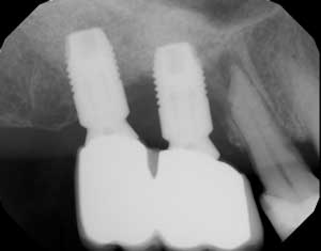 Have infection, will travel: Paving the path to dental implant failure ...
