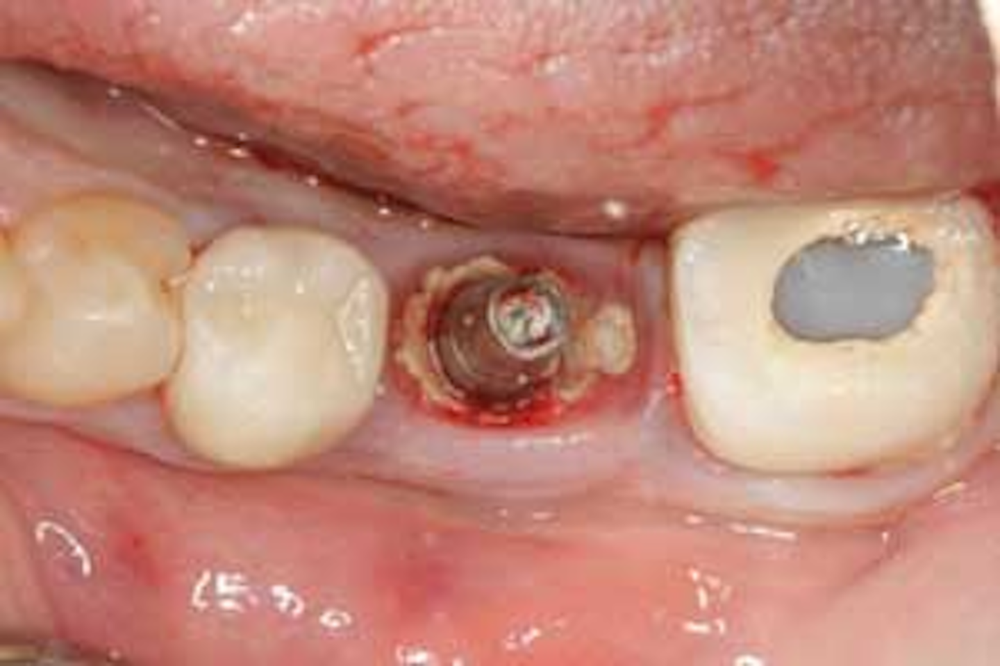 Prosthetic screw loosening: An innovative technique to manage a common ...