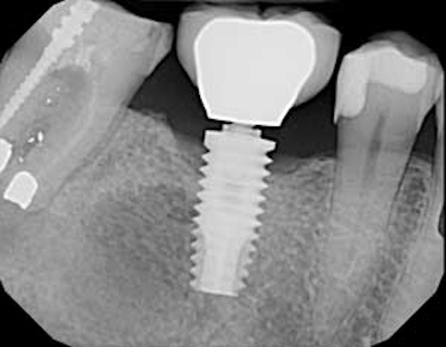 Prosthetic screw loosening: An innovative technique to manage a common ...