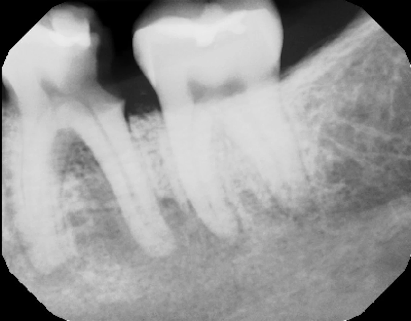 Socket debridement paresthesia: A popular method of unintentionally ...