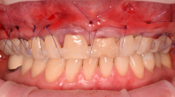 Minimally invasive soft-tissue grafting: The GumDropTechnique | Perio ...