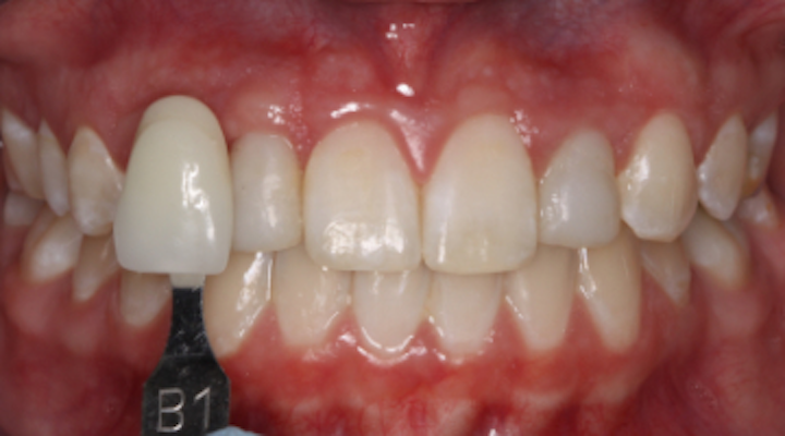 Gingival contouring using dental implant provisional restorations in ...
