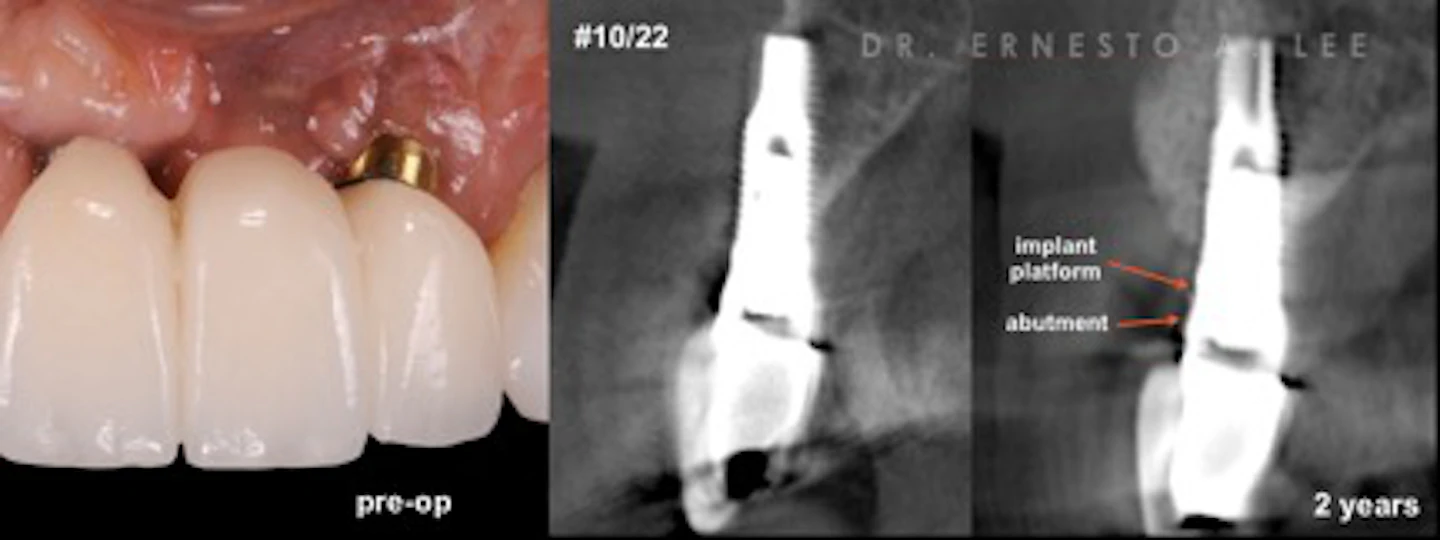 Treatment of exposed dental implant surfaces with the minimally ...