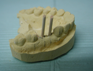 Radiographic guides and surgical guide stents for dental implants ...