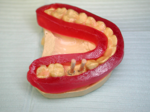 Radiographic guides and surgical guide stents for dental implants ...