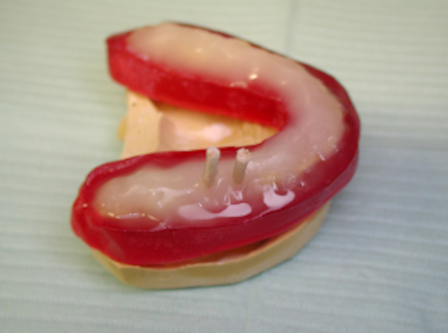 Radiographic guides and surgical guide stents for dental implants ...