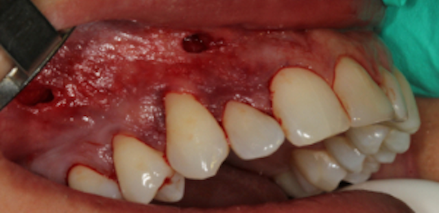 Pinhole Surgical Technique: The rebirth of the noninvasive soft-tissue ...