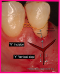 A new coronally advanced, noninvasive, soft-tissue grafting technique ...